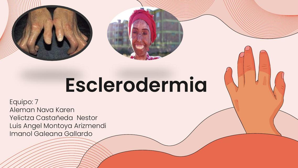 Esclerodermia | KAREN ALEMAN NAVA | uDocz