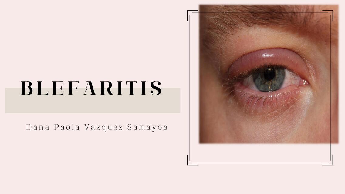 Blefaritis | Dana Vazquez | uDocz
