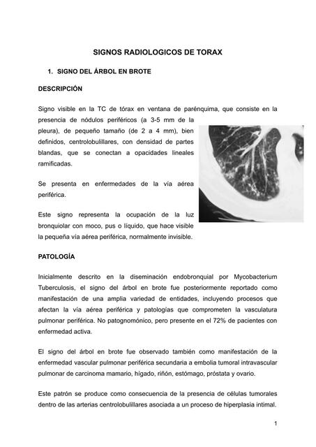 Signos Radiológicos de Tórax | Maria Reneé | uDocz