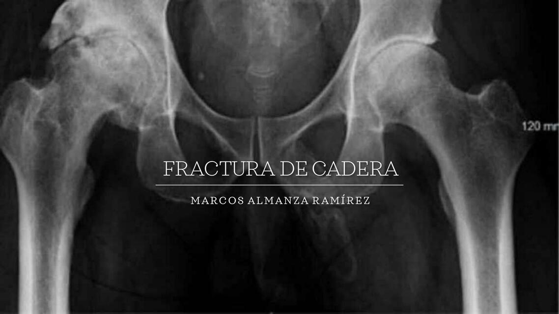 Fractura De Cadera Jessy González Udocz