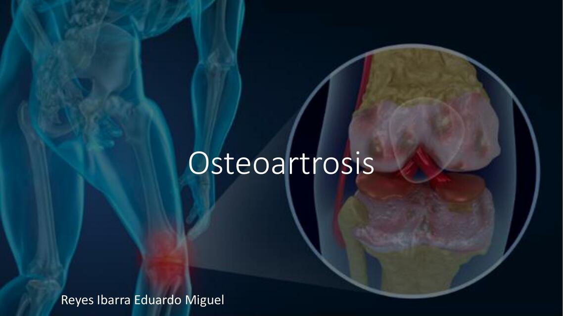 Osteoartrosis | Jessy González | uDocz