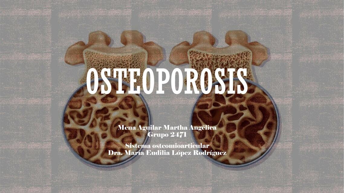 OSTEOPOROSIS | Angélica Mena | uDocz