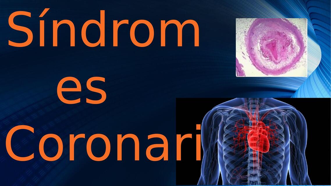 Síndromes coronarios | IOVANNY CRUZ OJEDA | uDocz