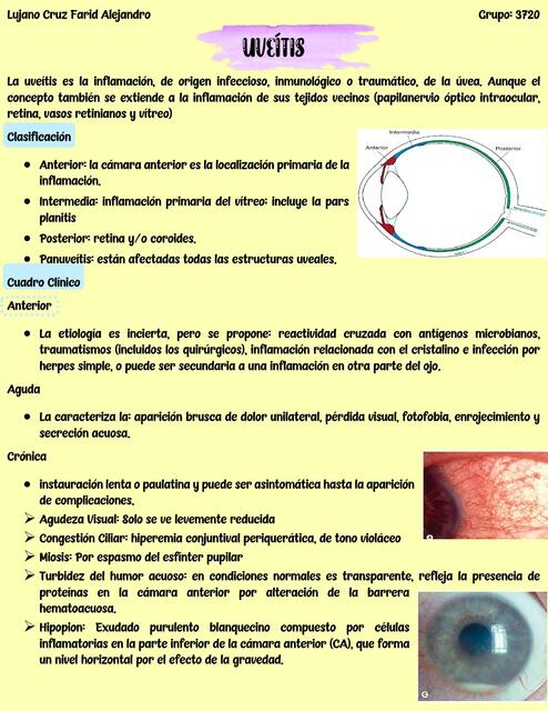 Resumen uveítis | IOVANNY CRUZ OJEDA | uDocz