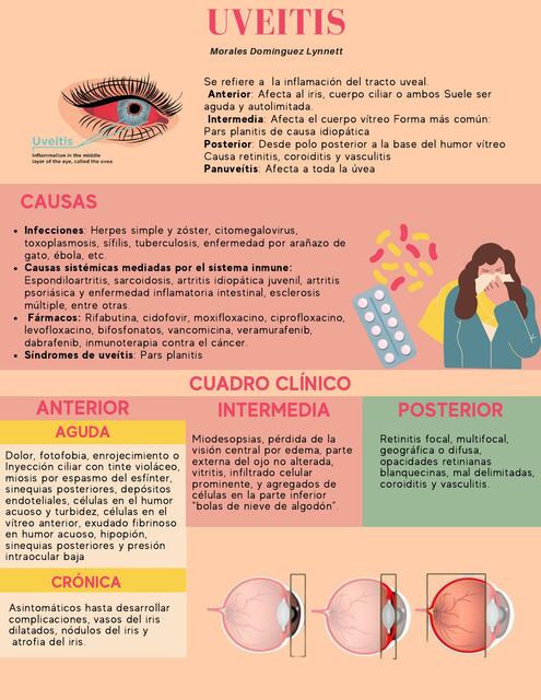Resumen uveitis | IOVANNY CRUZ OJEDA | uDocz