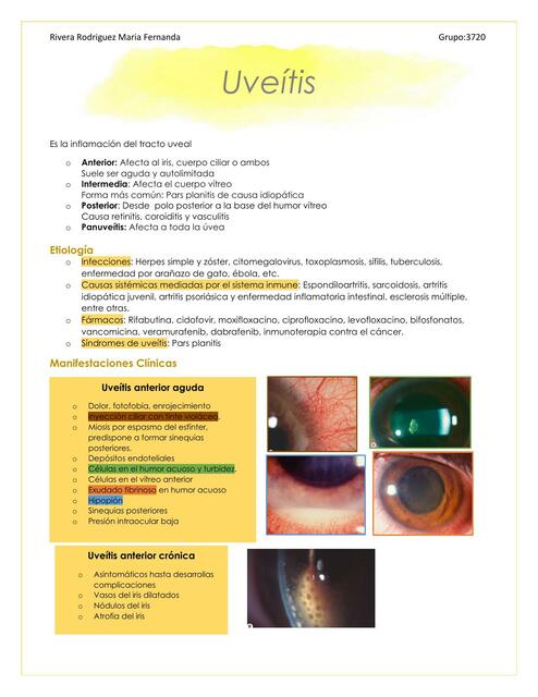 Resumen uveitis | IOVANNY CRUZ OJEDA | uDocz