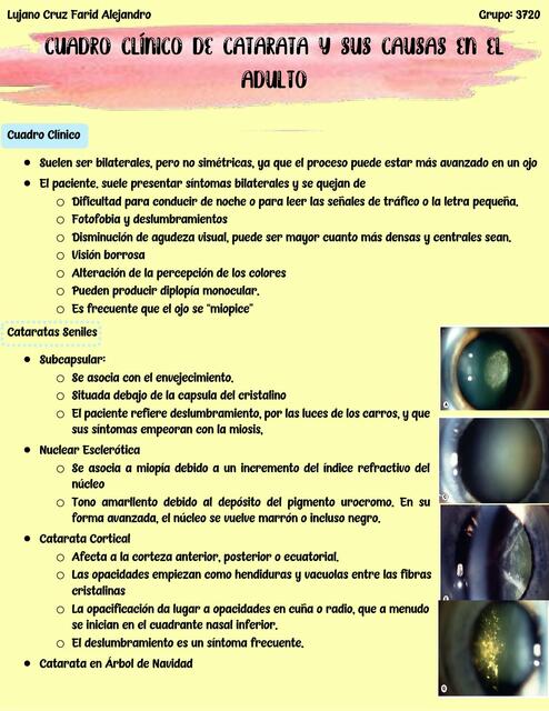 Cataratas cuadro clinico y causas resumen | IOVANNY CRUZ OJEDA | uDocz