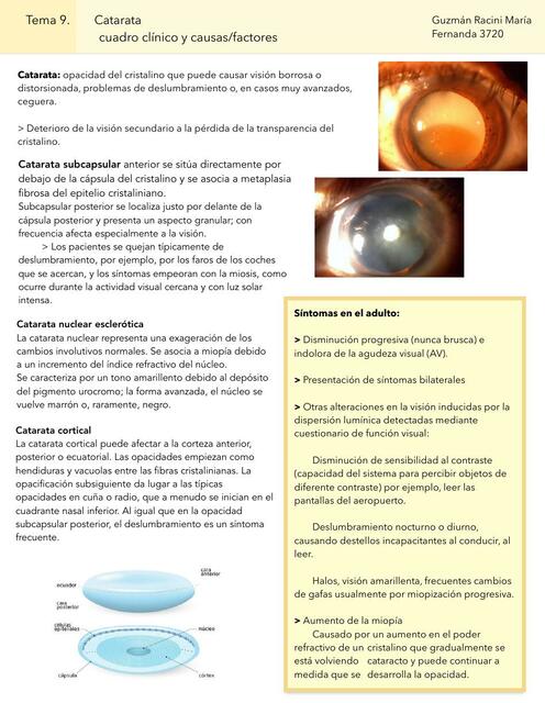 Cataratas cuadro clinico y causas resumen | IOVANNY CRUZ OJEDA | uDocz