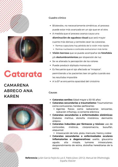 Cataratas cuadro clinico y causas resumen | IOVANNY CRUZ OJEDA | uDocz