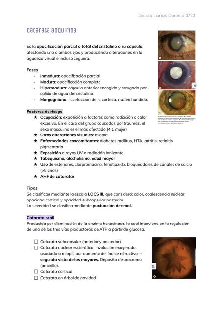 Cataratas cuadro clinico y causas resumen | IOVANNY CRUZ OJEDA | uDocz