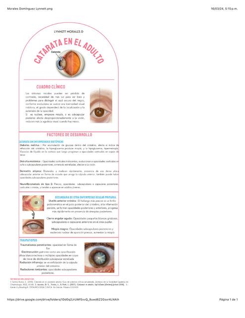 Cataratas cuadro clinico y causas resumen | IOVANNY CRUZ OJEDA | uDocz