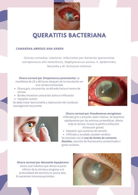 Queratitis bacteriana resumen | IOVANNY CRUZ OJEDA | uDocz