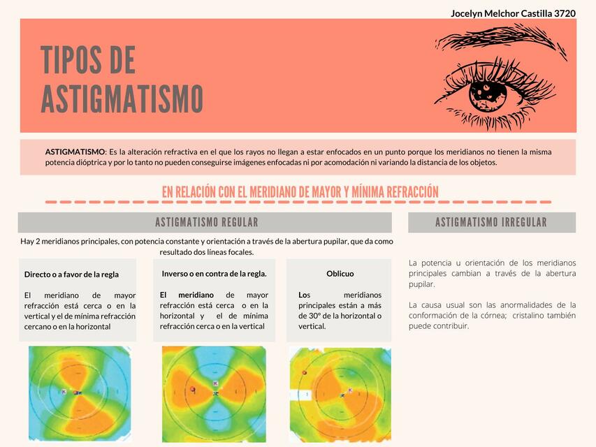 Tipos de astigmatismo | IOVANNY CRUZ OJEDA | uDocz