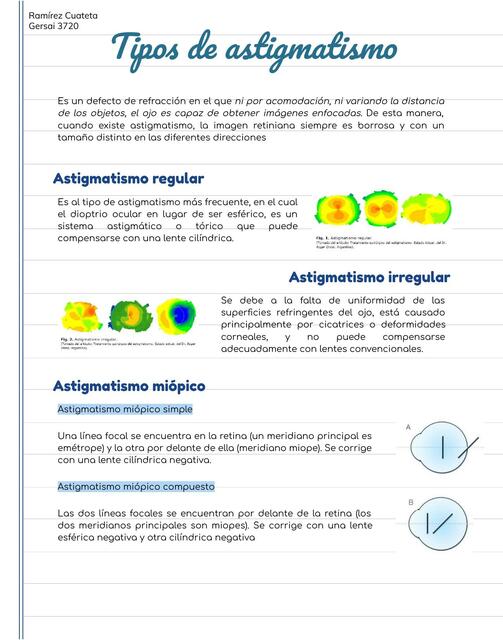 Tipos de astigmatismo | IOVANNY CRUZ OJEDA | uDocz