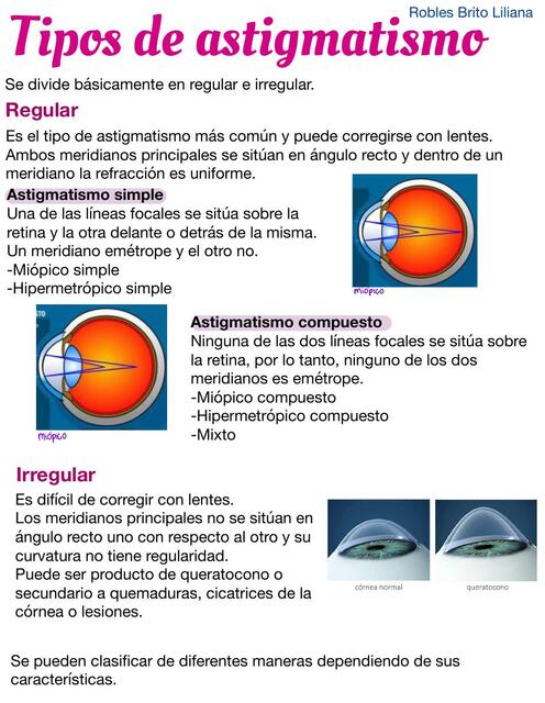 Tipos de astigmatismo | IOVANNY CRUZ OJEDA | uDocz