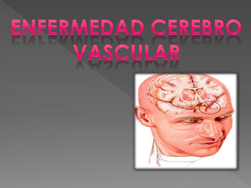 Enfermedad Cerebro Vascular Jafet Ríos Udocz