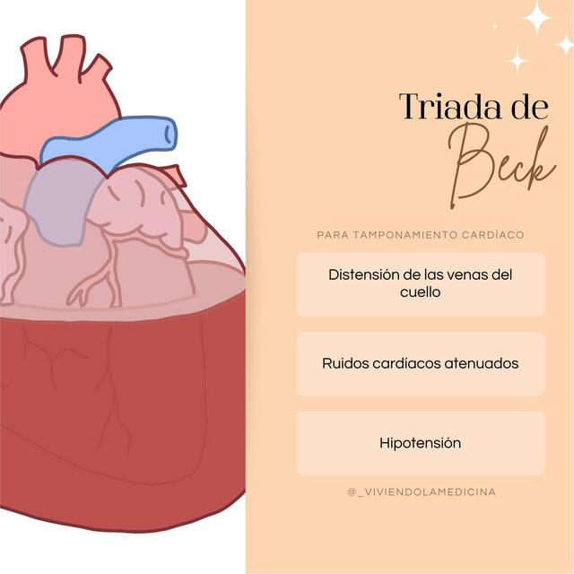 Triada de Beck | Viviendo la medicina | uDocz