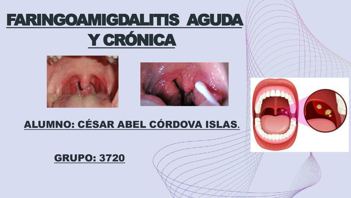 Faringoamigdalitis aguda y crónica | IOVANNY CRUZ OJEDA | uDocz