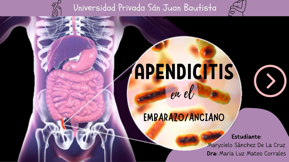 Apendicitis embarazo y anciano | Marycielo Sanchez de la Cruz | uDocz