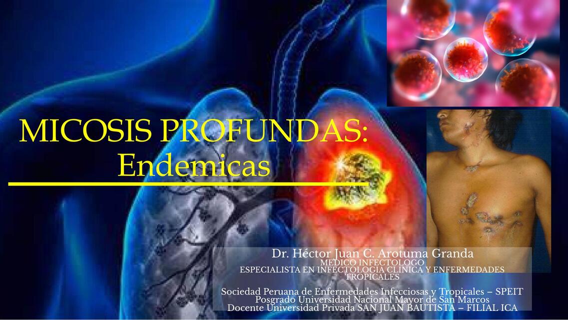 Micosis profundas: Endémicas | MARK HAM | uDocz