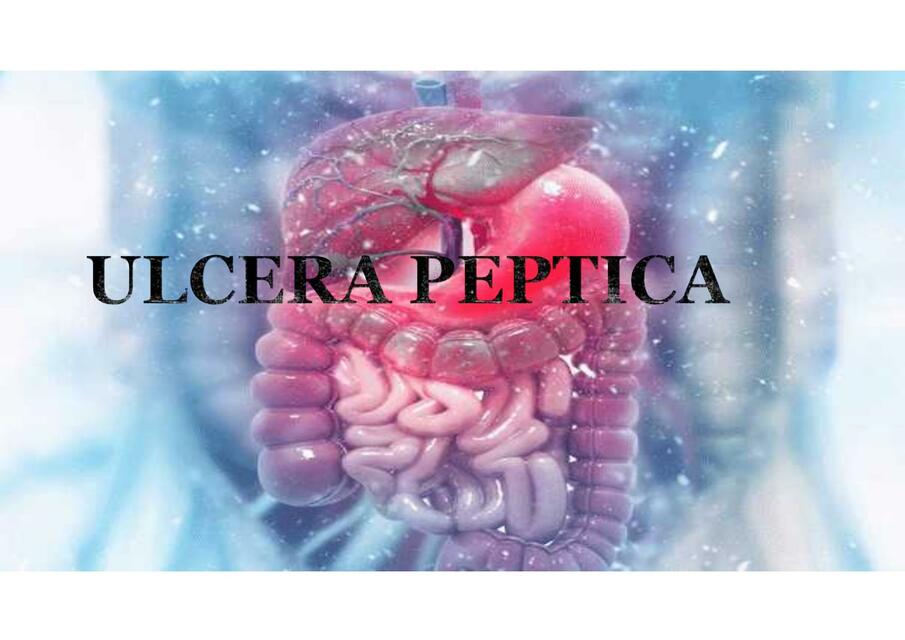 Ulcera Peptica | Medical Coffe | uDocz