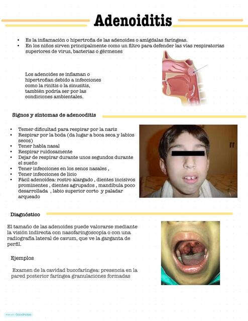 Adenoiditis | alondra | uDocz