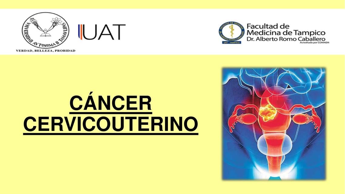 Cancer cervicouterino | uDocz