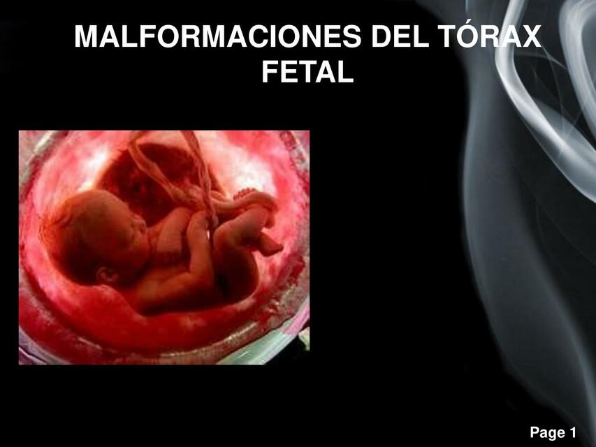 Malformaciones del torax fetal | Arnold Alvarez | uDocz