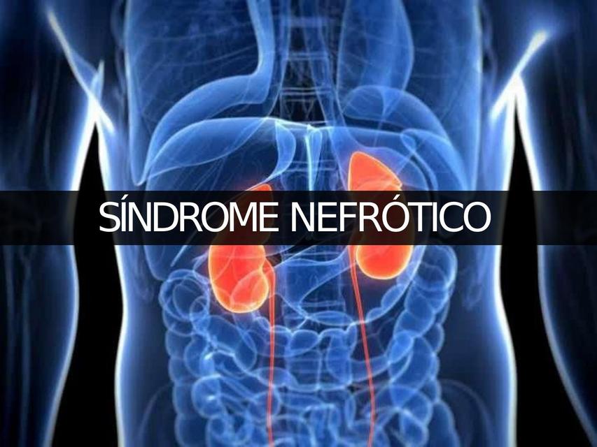 sindrome nefrotico | daniel vidals | uDocz