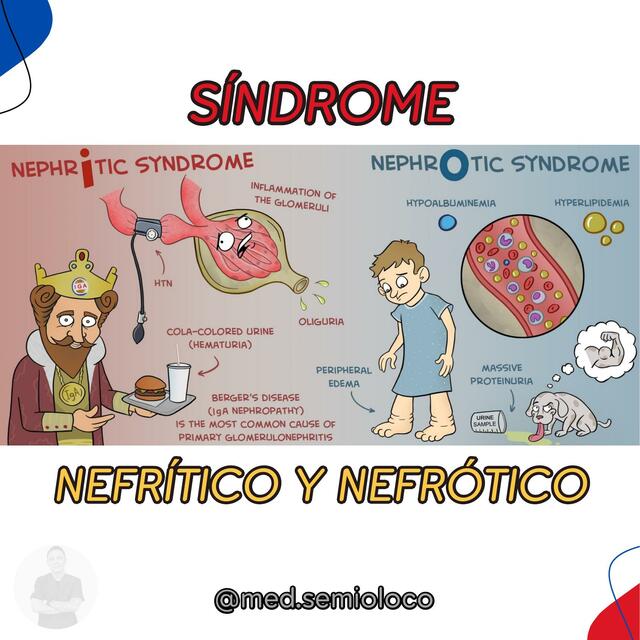 Síndrome Nefrítico y Nefrótico | Víctor Rodriguez Botero - @med ...