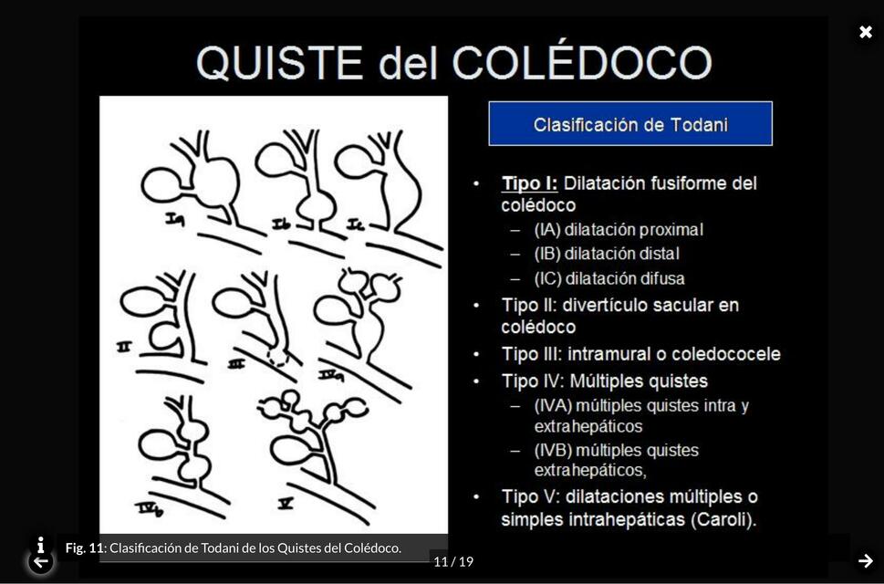 Quiste de coledoco | ALEJANDRO RIOS VELASQUEZ | uDocz
