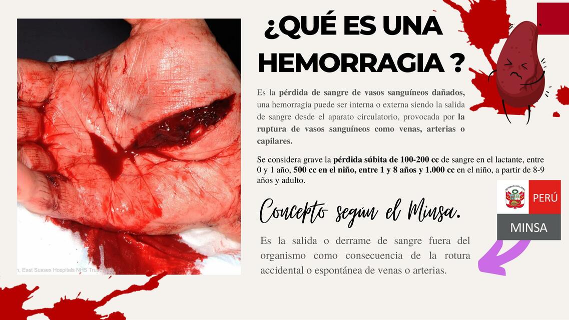 La Hemorragia | MARLEY ROSALIND ELIZAMA VERA BARRETO | uDocz