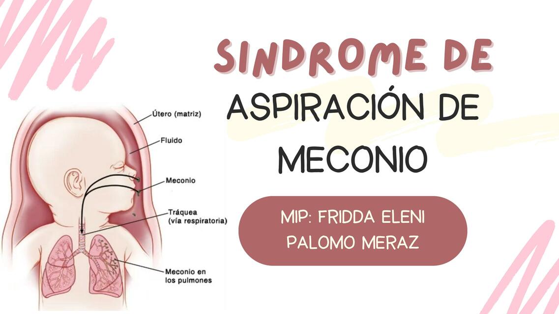 Resúmenes de Síndrome de aspiración meconial | Descarga apuntes de ...