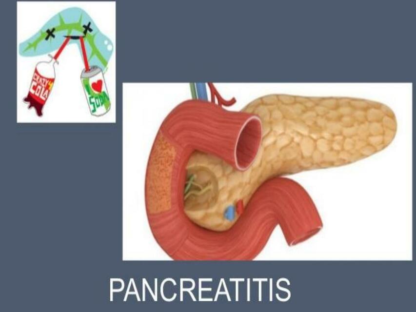 Pancreatitis Aguda | Guadalupe aylen Ugarte huallpa | uDocz