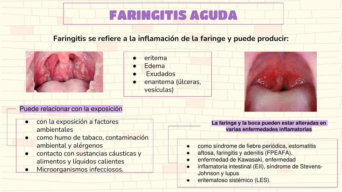 Faringitis aguda | Health classes | uDocz