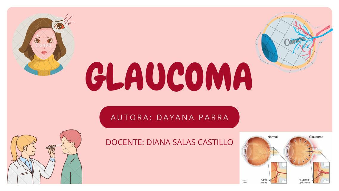 Glaucoma | Dayana Mylenka Parra Cordova | uDocz