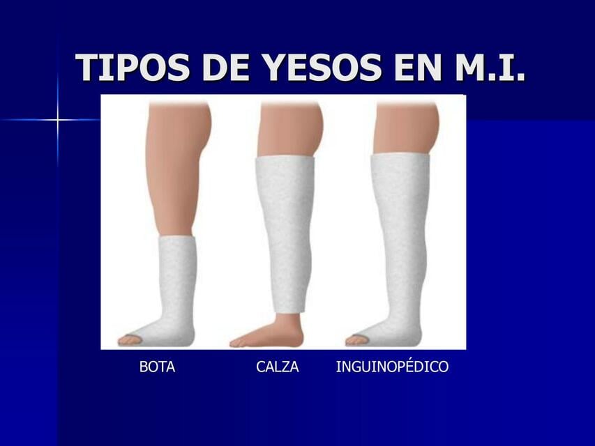Tipos de Yesos en M.I. | elsa mia | uDocz