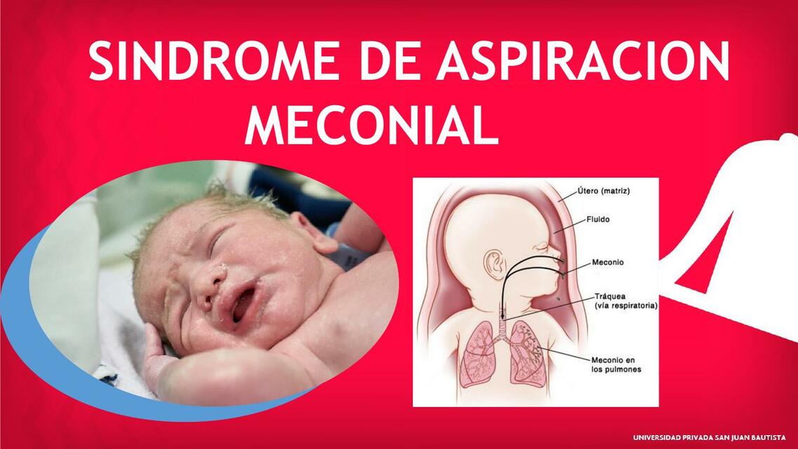 SINDROME DE ASPIRACIÓN MECONIAL | Neisse Katherin Ramírez Herrera | uDocz