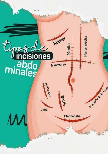 Tipos de incisiones abdominales | fraii | uDocz