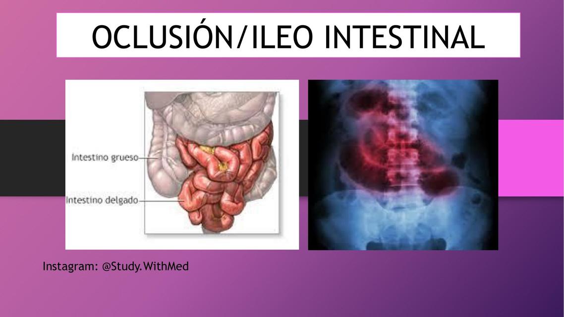 Íleo Intestinal - Semiología | StudyWithMed | uDocz