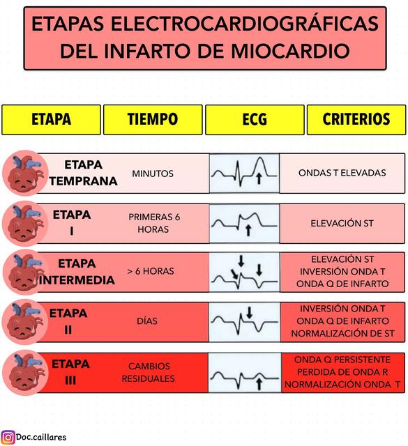 ETAPAS ELECTROCARDIOGRÁFICAS DEL INFARTO DE MIOCARDIO | Dr. Boris ...