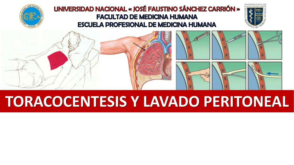 TORACOCENTESIS Y LAVADO PERITONEAL | Apuntes Medicos | uDocz