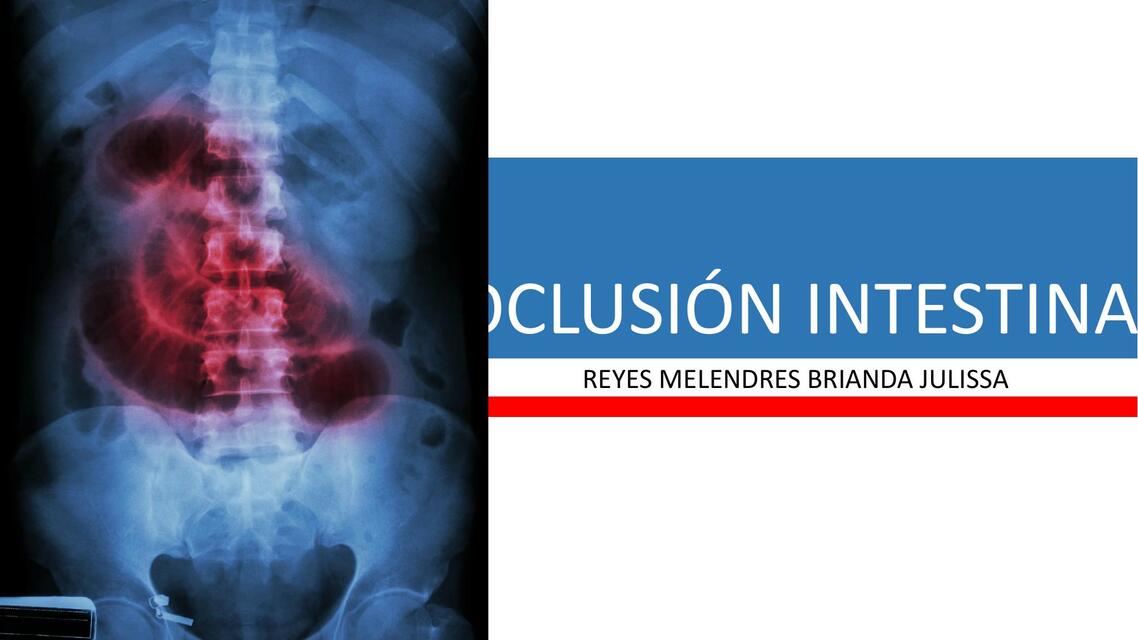 Oclusión intestinal | Bri Reyes | uDocz