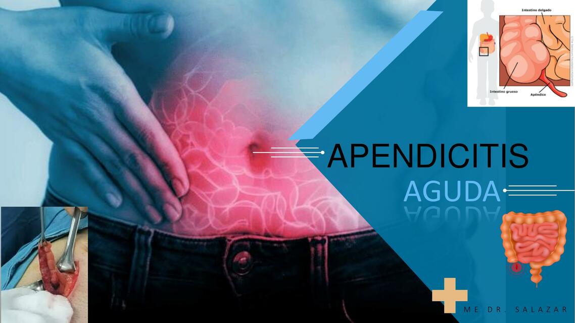 APENDICITIS AGUDA CIRUGIA | Fernando | uDocz