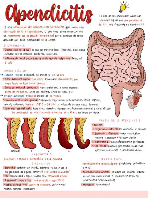 Apendicitis | Erickson | uDocz