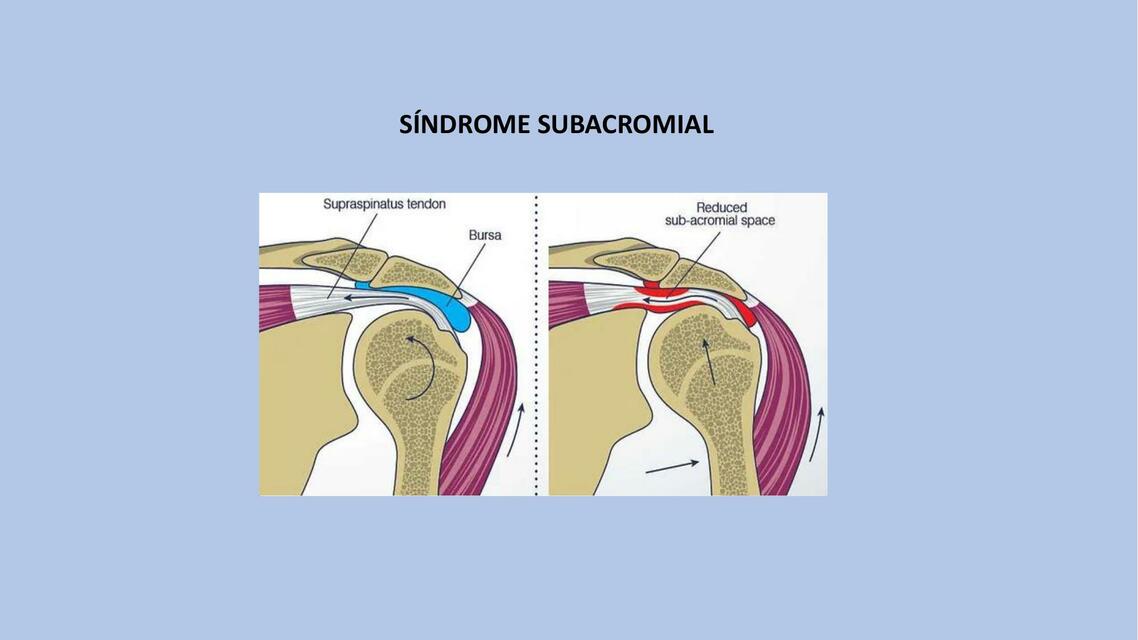 sindrome subacromial | B.M.GFisioterapia Apuntes y demás | uDocz