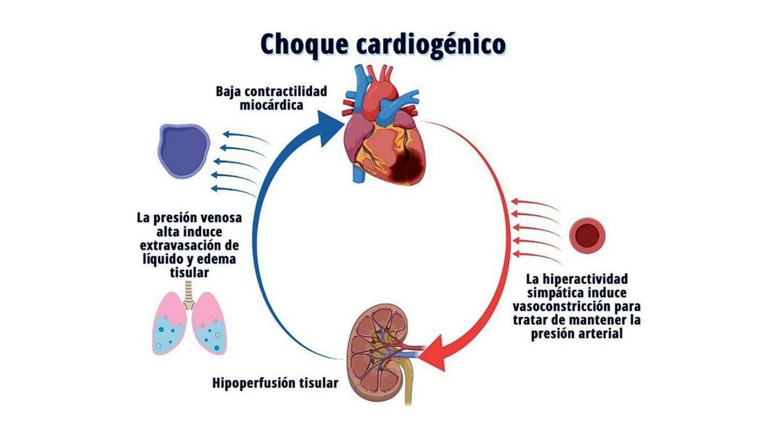 shock cardiogenico | B.M.GFisioterapia Apuntes y demás | uDocz