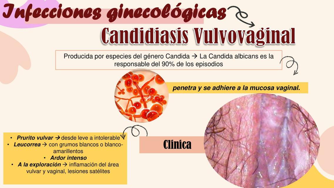 Candidiasis Vulvovaginal | Medicina Óptima | uDocz
