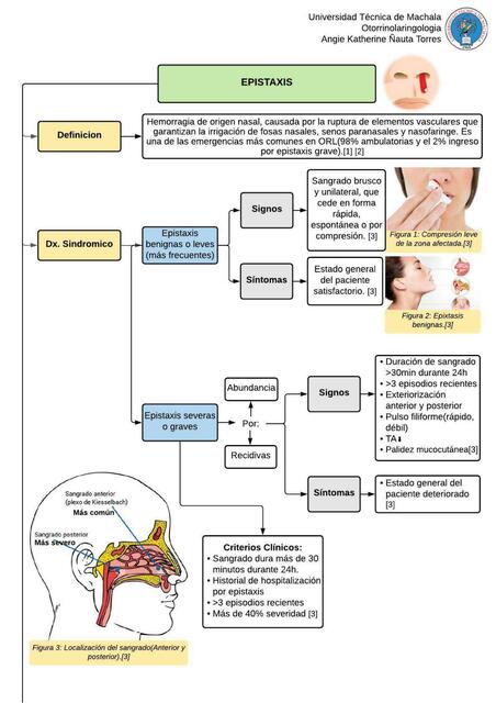 EPISTAXIS | Marko Echevarría | uDocz EPISTAXIS | Marko Echevarría | uDocz