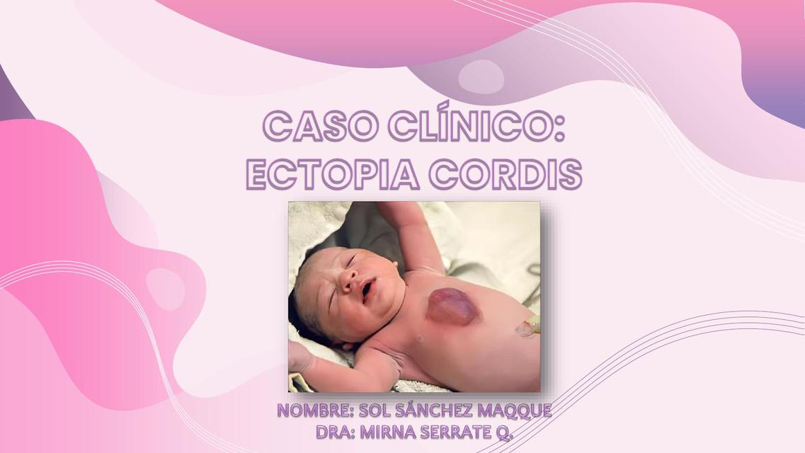 MALFORMACIONES CONGENITAS:ECTOPIA CORDIS | Sol Sánchez | uDocz